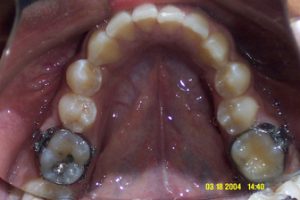 Braces – The Orthodontic Centre Limited